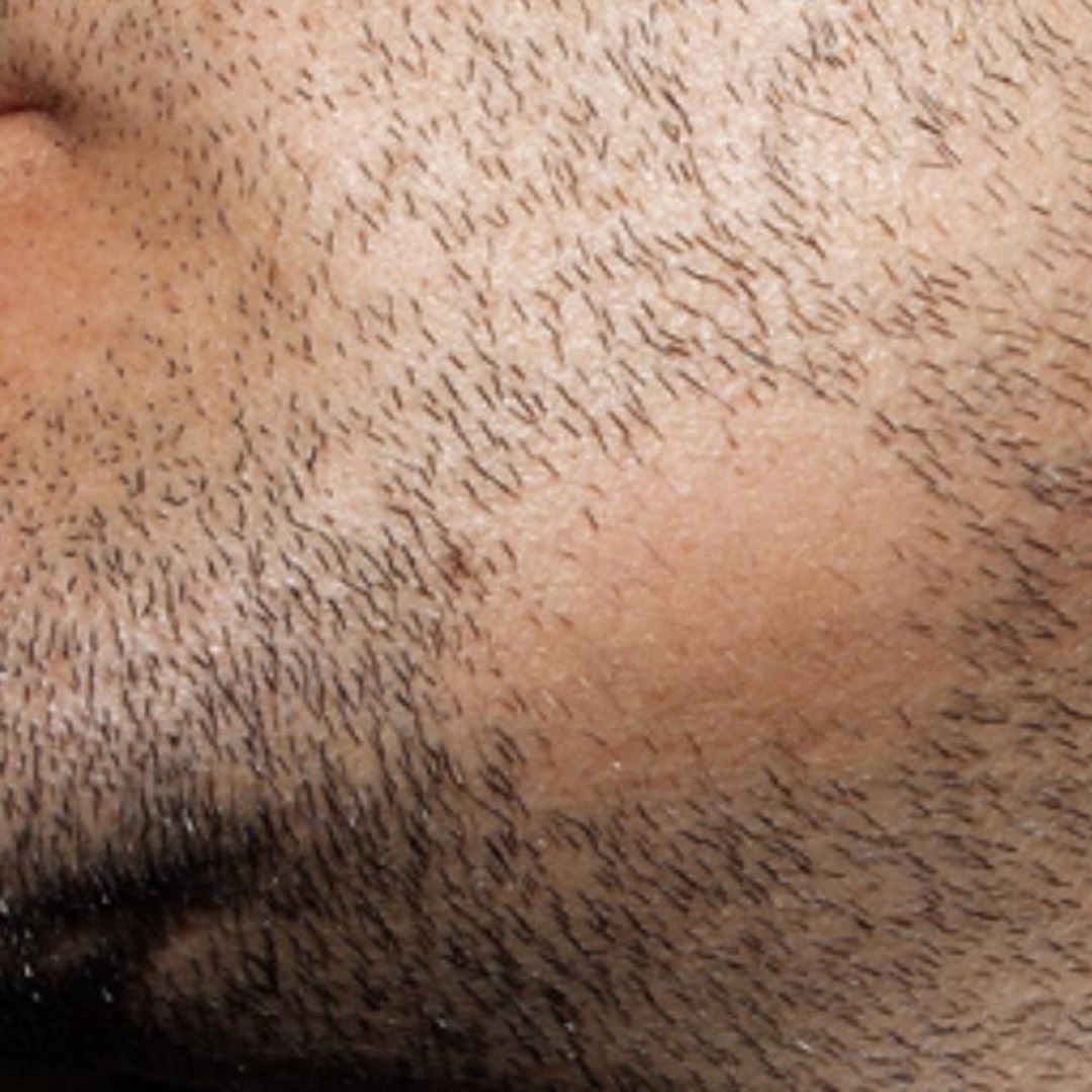 Beard Pigmentation – Ultra Scalp Ink